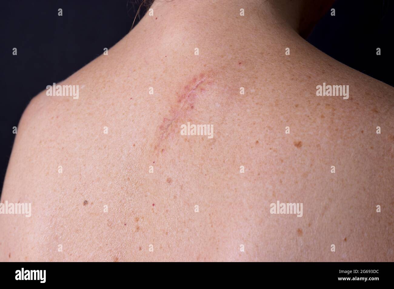 Scar on the back of a woman after the stitches have been removed Stock ...