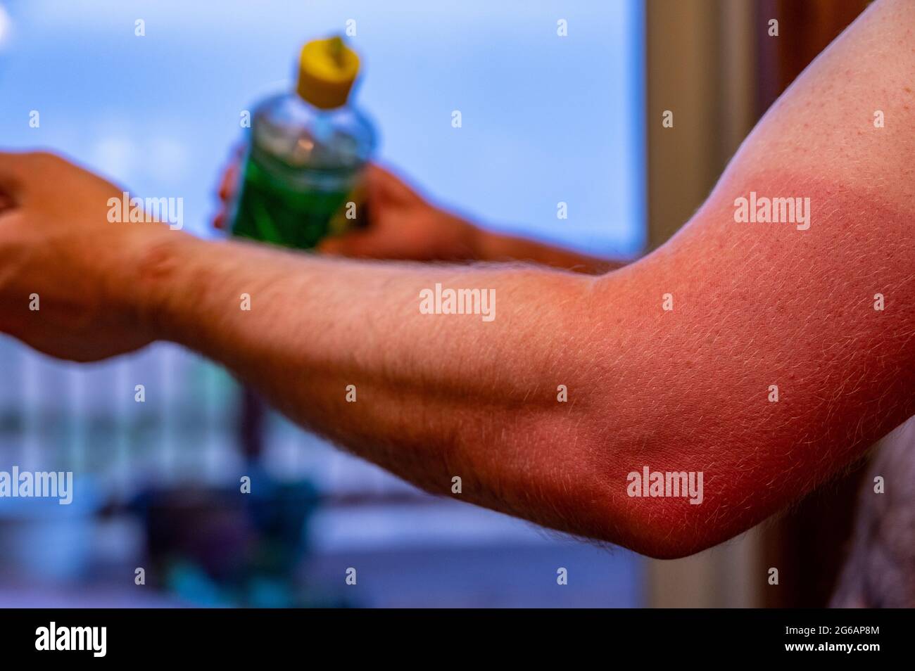 applying aloe vera gel to a red sunburn on an arm Stock Photo - Alamy