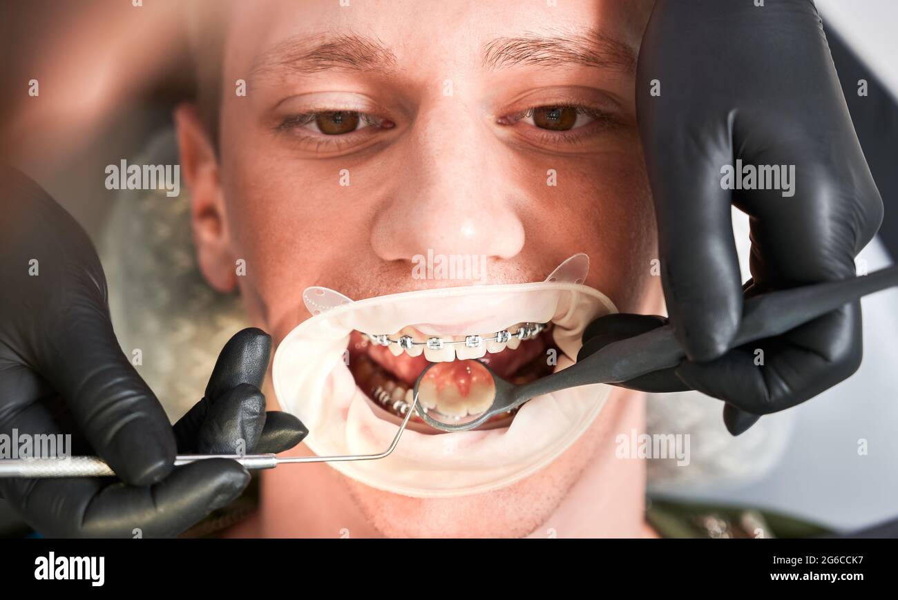 Close up of orthodontist examining man teeth with dental mirror and ...