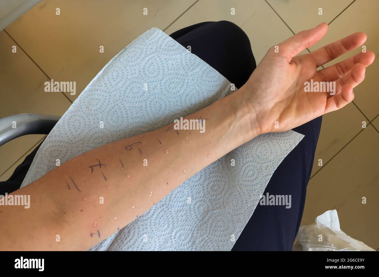 Process of Allergy Skin Test on the hand of Patient Stock Photo - Alamy