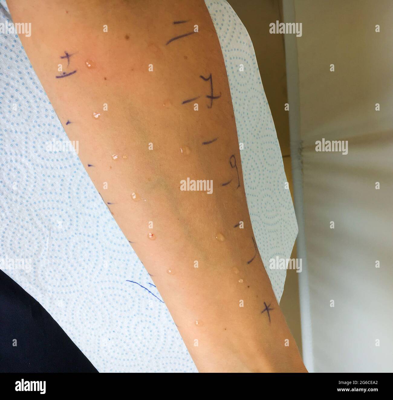 Process of Allergy Skin Test on the hand of Patient Stock Photo - Alamy