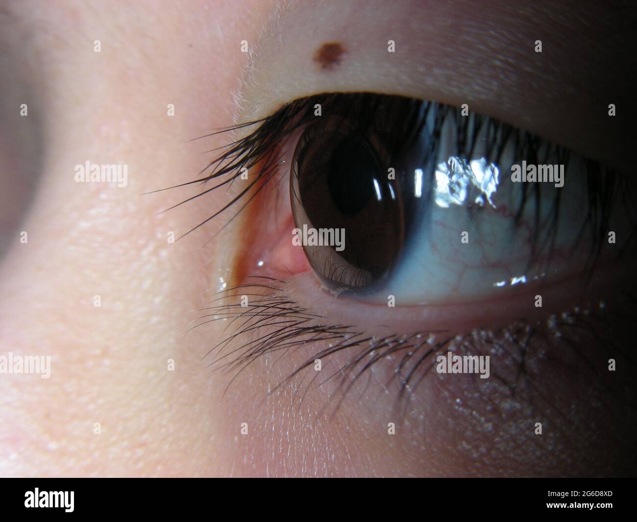 Lens on Eye Ball - Asian Eyelid Stock Photo - Alamy