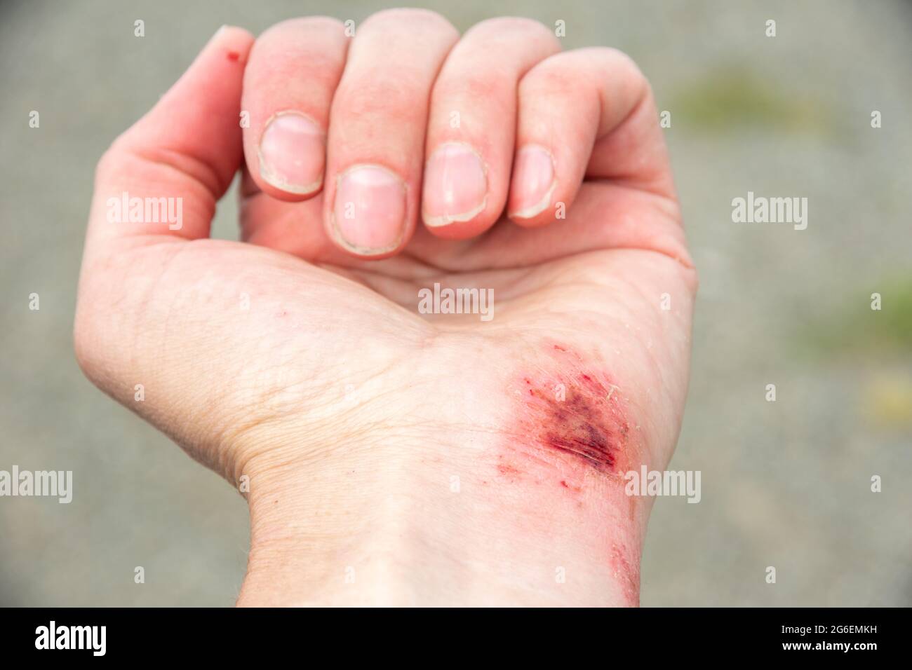 Redness in palm hi-res stock photography and images - Alamy