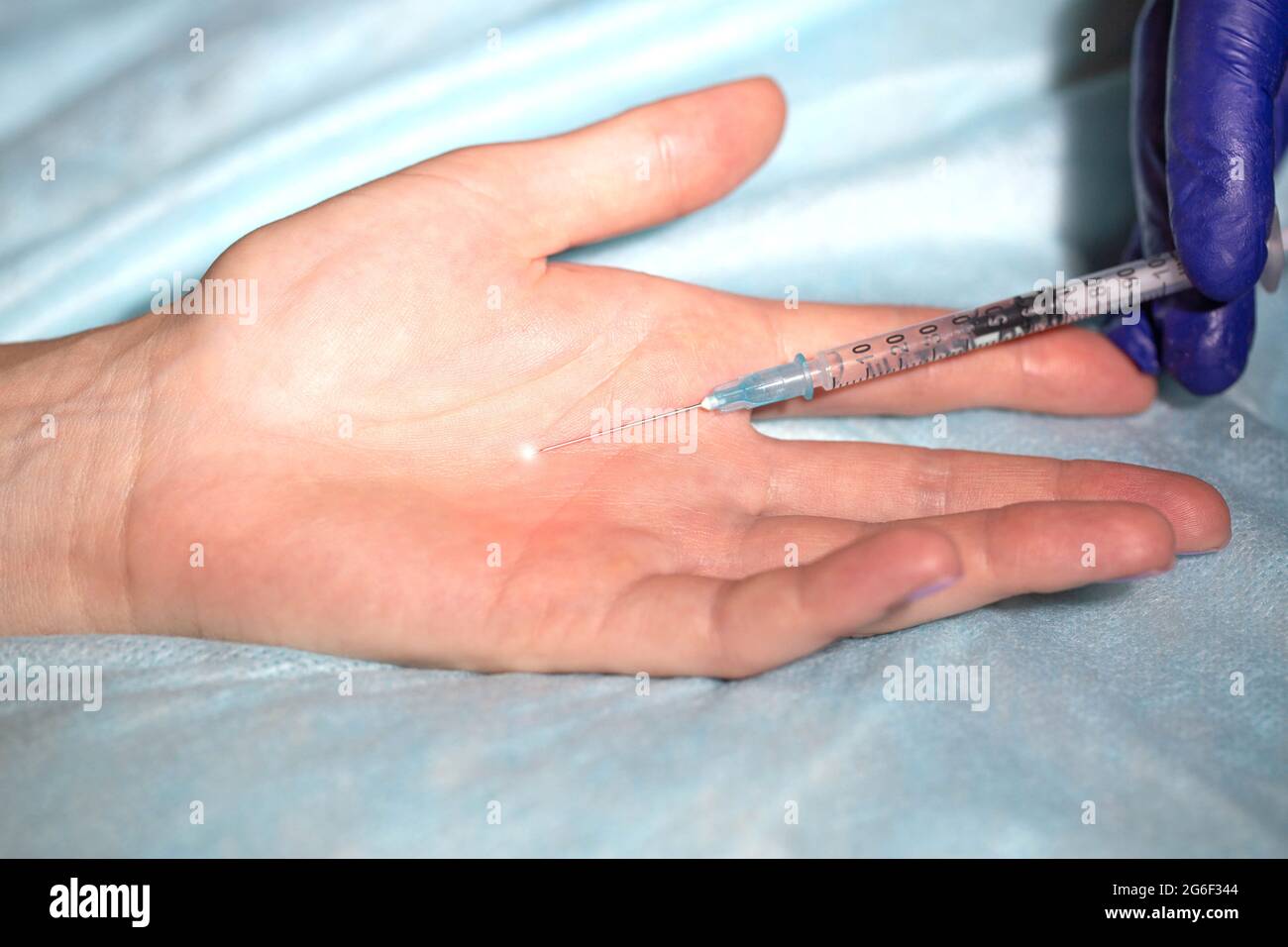 Anti-sweating injections into the patient's palm. Hyperhidrosis ...