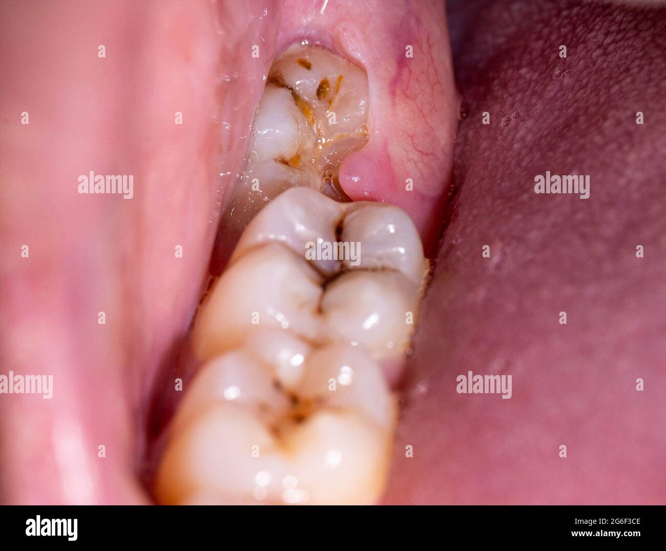 Gum Infection Behind Molar