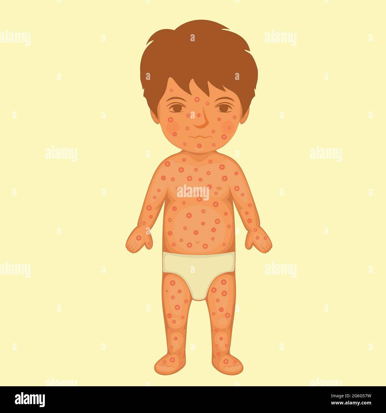 sick child, skin rash, chicken pox disease Stock Vector Image & Art - Alamy