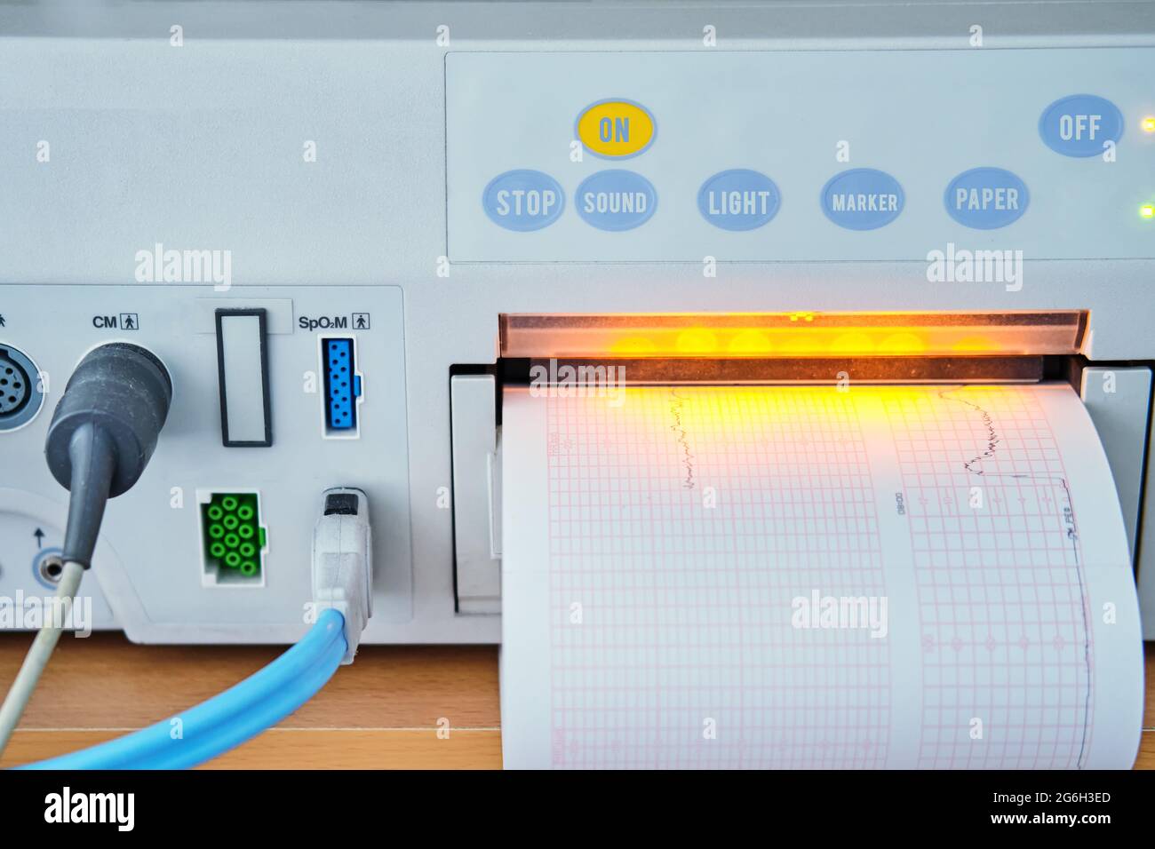 CTG device with monitoring of the state of health of the mother and ...