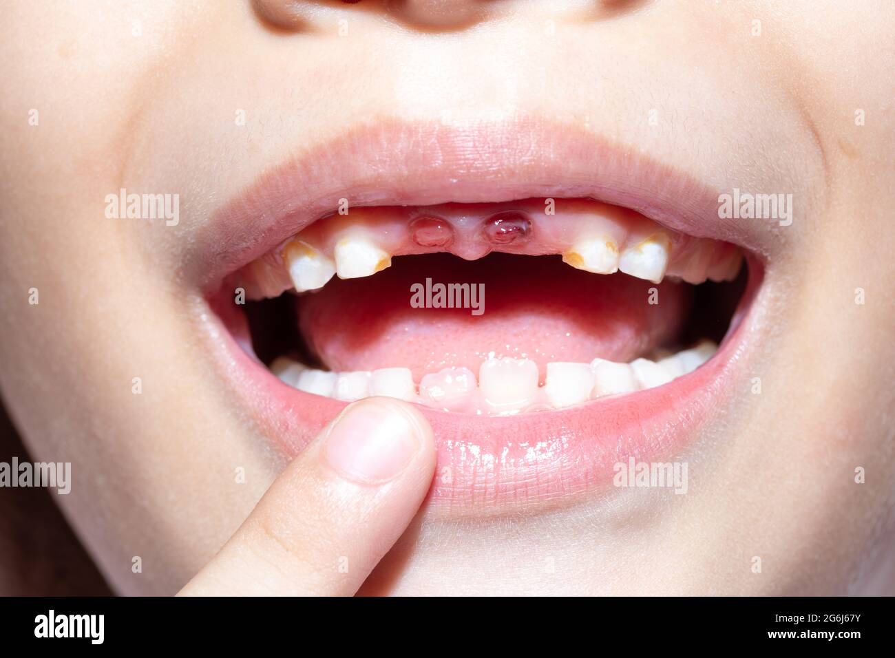 A 5-year-old boy whose upper milk tooth incisor fell out. Kid patient ...