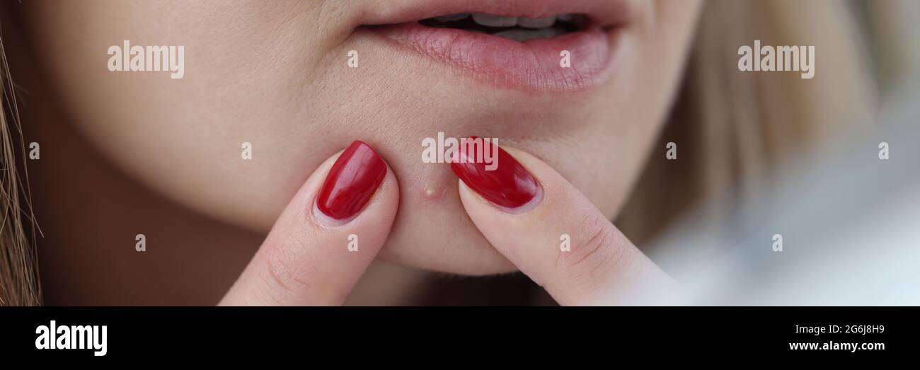 Squeezing Pimple Zit High Resolution Stock Photography and Images - Alamy