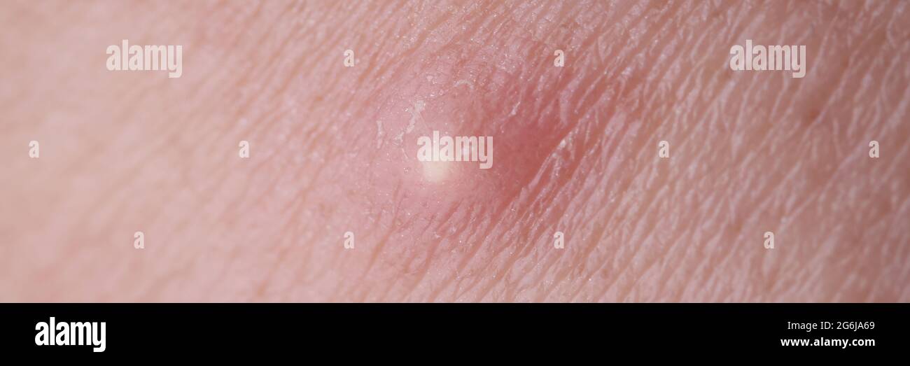 Pimple with purulent discharge on skin closeup Stock Photo - Alamy