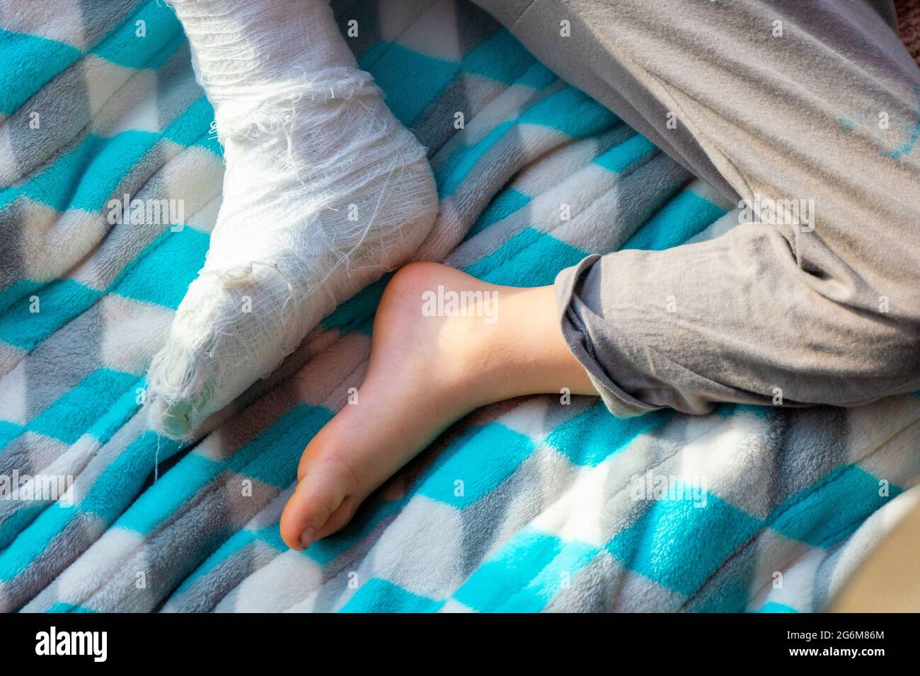 Child with bandage on leg heel fracture. Broken right foot, bone, calf ...