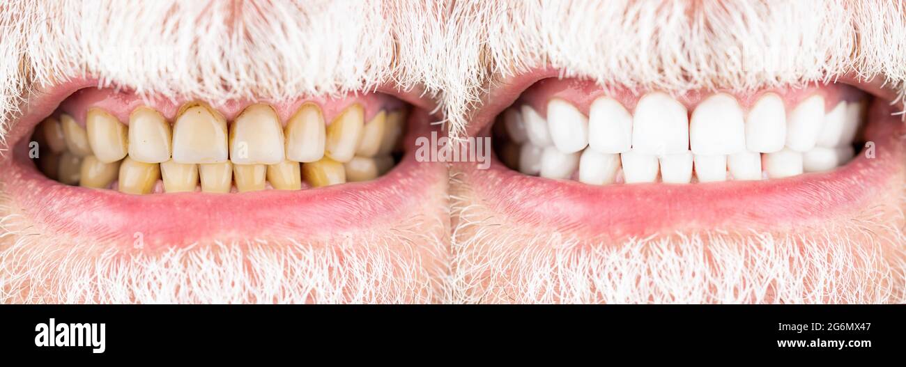 Close-up Of A Smiling man Teeth Before And After Whitening. Male teeth ...