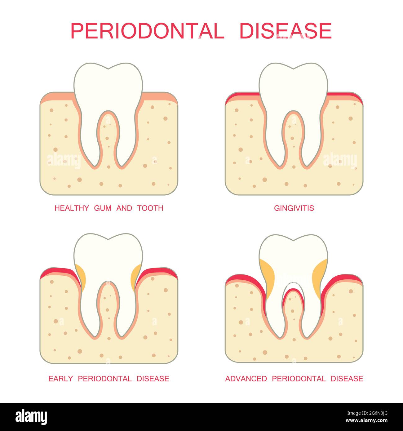 tooth periodontal disease, dental gum periodontists Stock Vector Image ...