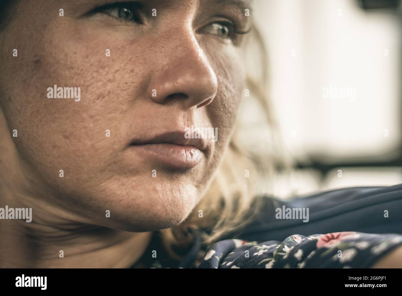 Close-up side portrait young woman real problem face skin cheek acne ...