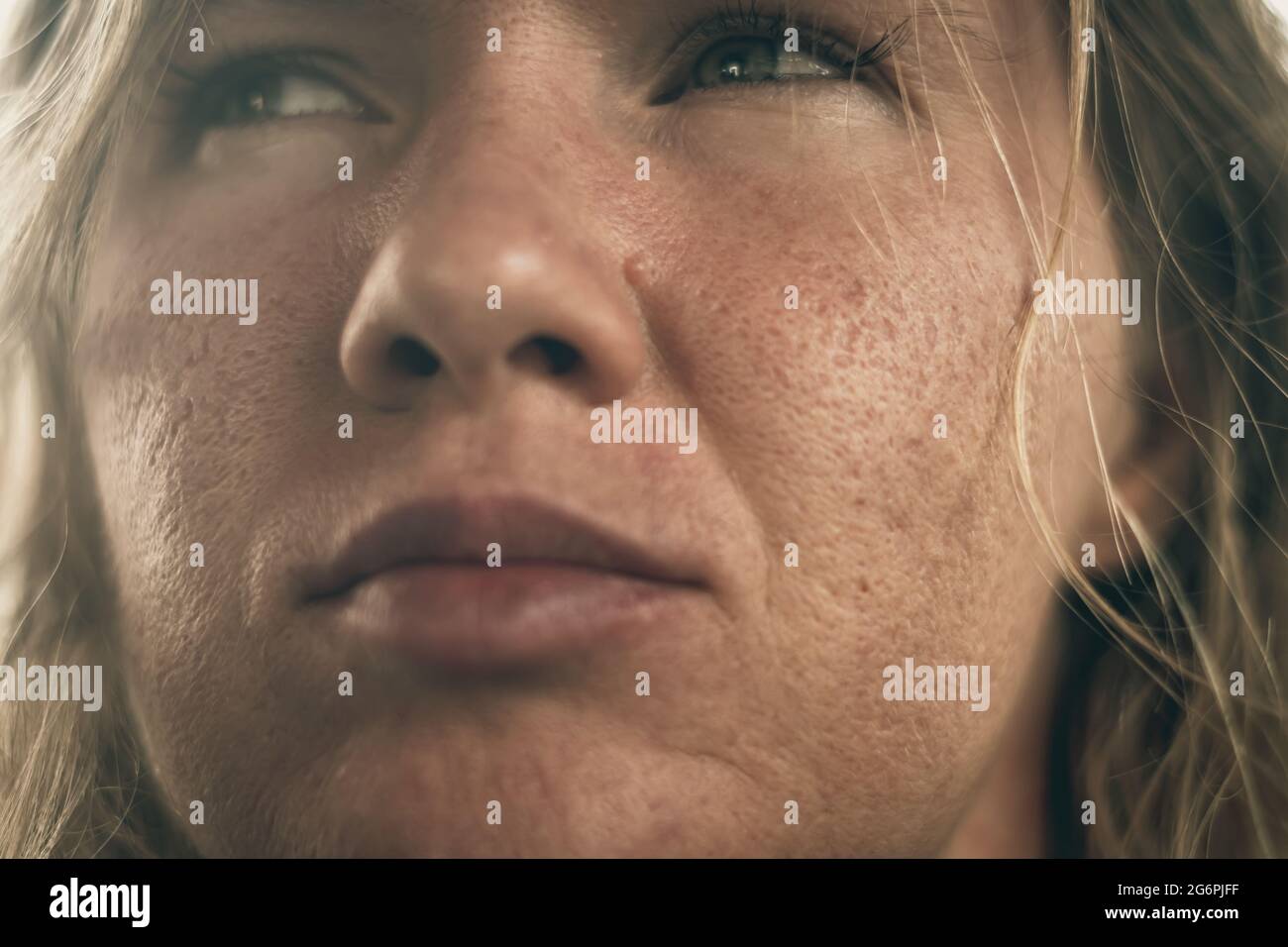 Close-up side portrait young woman real problem face skin cheek acne ...