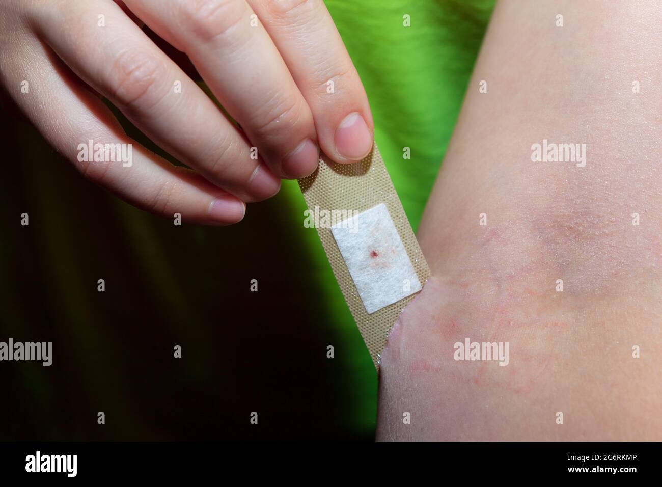Band aid is removed after injection . Blood stain on the bandage after ...