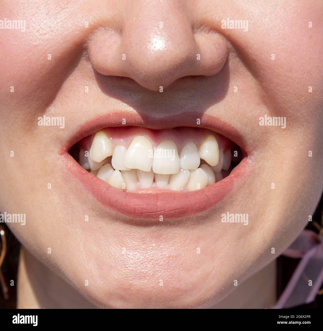Curved female teeth, before installing braces. Close - up of teeth ...