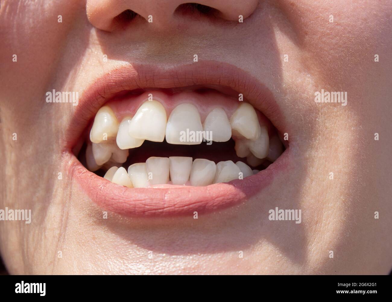 Curved female teeth, before installing braces. Close - up of teeth ...