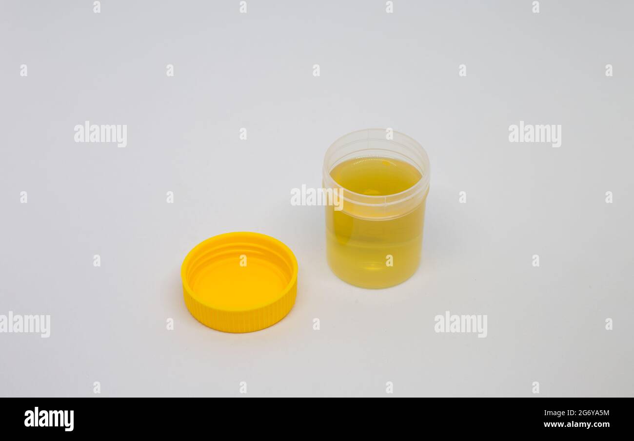 Closeup of a medical container with urine isolated on white background ...