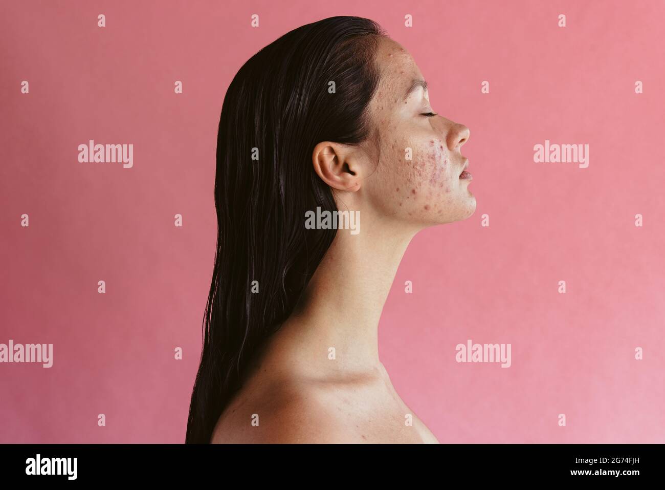 Woman redness skin face hi-res stock photography and images - Alamy