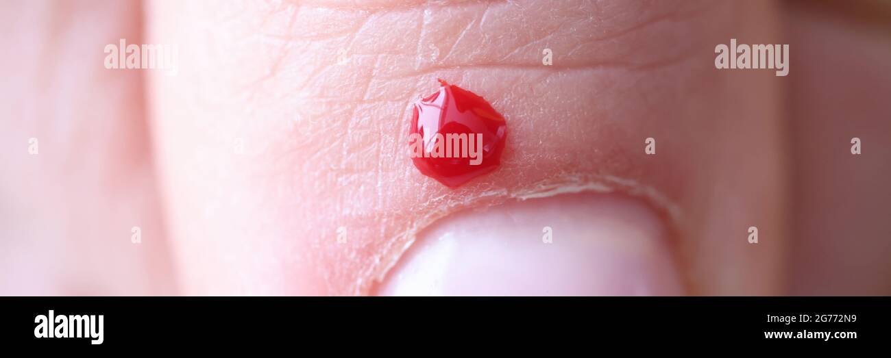 Puncture wound hi-res stock photography and images - Alamy