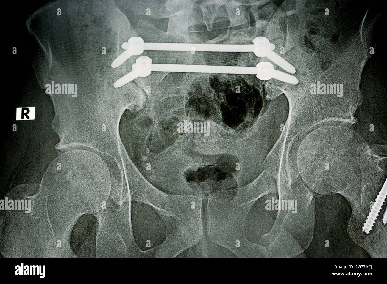 Sacrum Xray