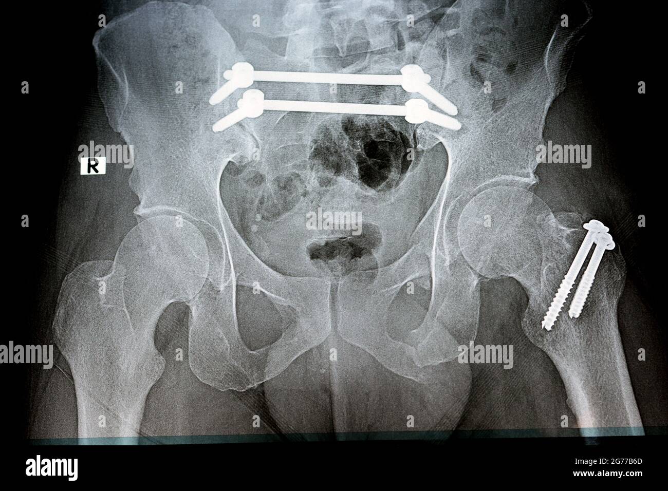Plain x ray with a fracture pelvis that is fixed with 4 screws and 2 ...