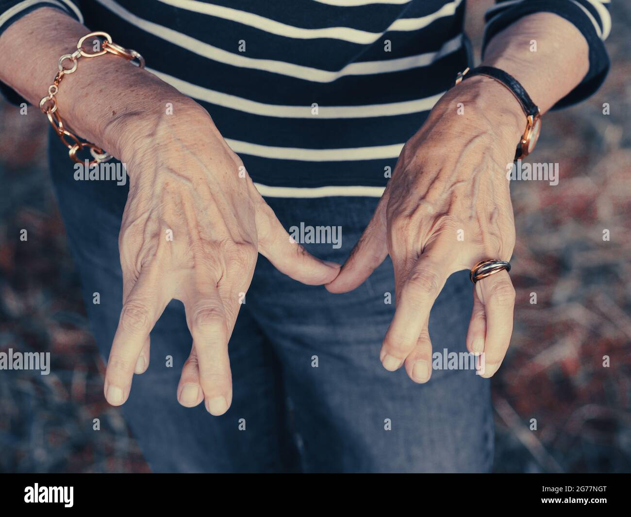 Senior lady hands -arthritis, aging Stock Photo - Alamy