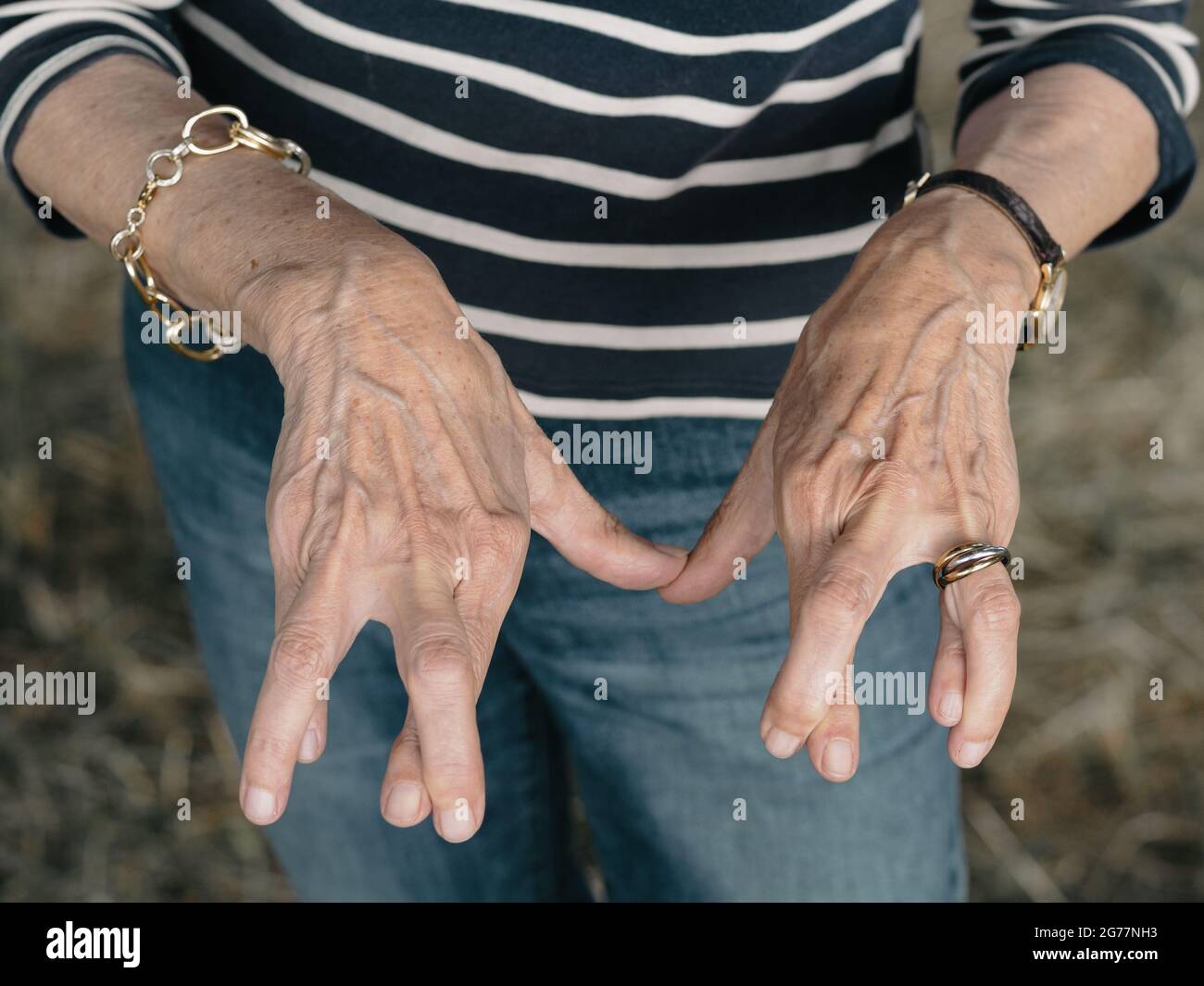 Senior lady hands -arthritis, aging Stock Photo - Alamy