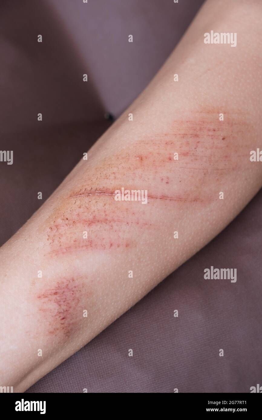 Wounds, scratches and abrasions on skin of child leg. Children injury ...