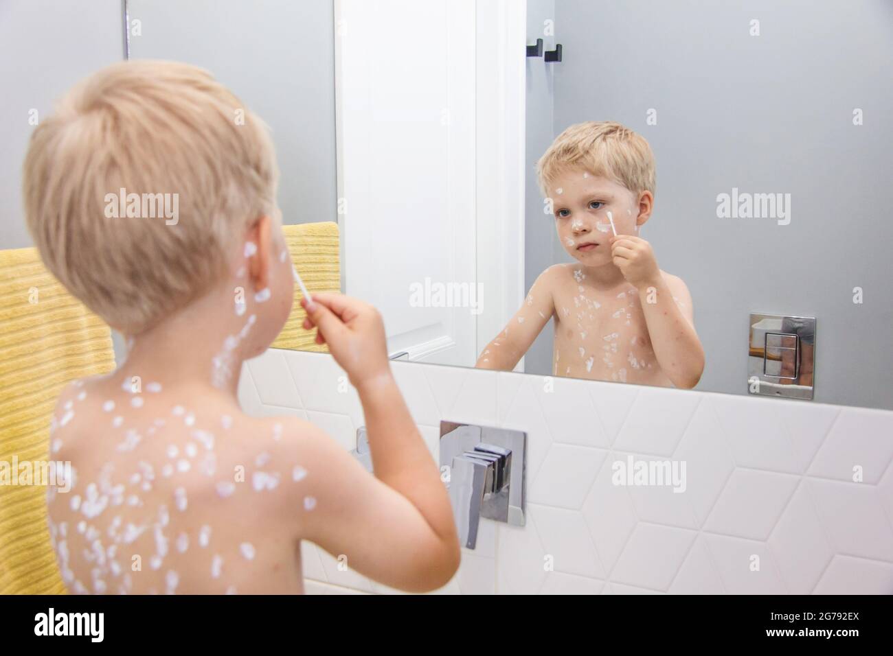 Chickenpox rash hi-res stock photography and images - Alamy
