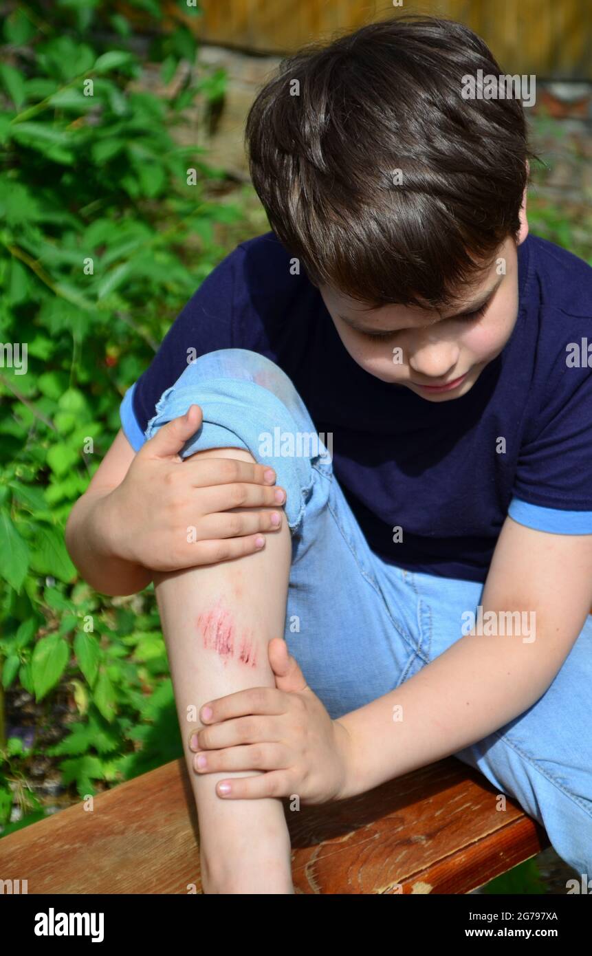 Closeup of injured young kid's knee after he fell down on pavement, the ...