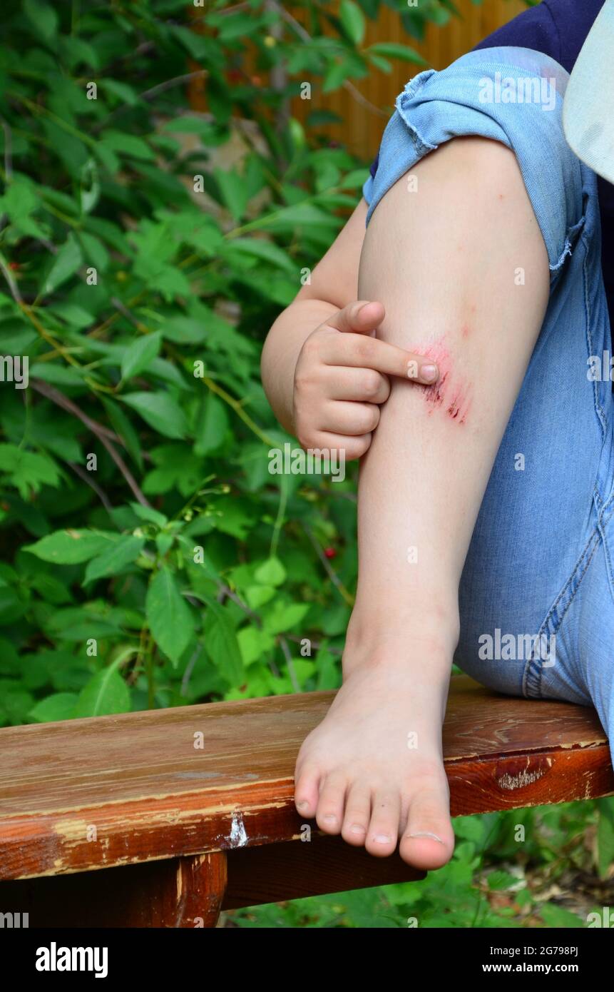 Closeup of injured young kid's knee after he fell down on pavement, the ...