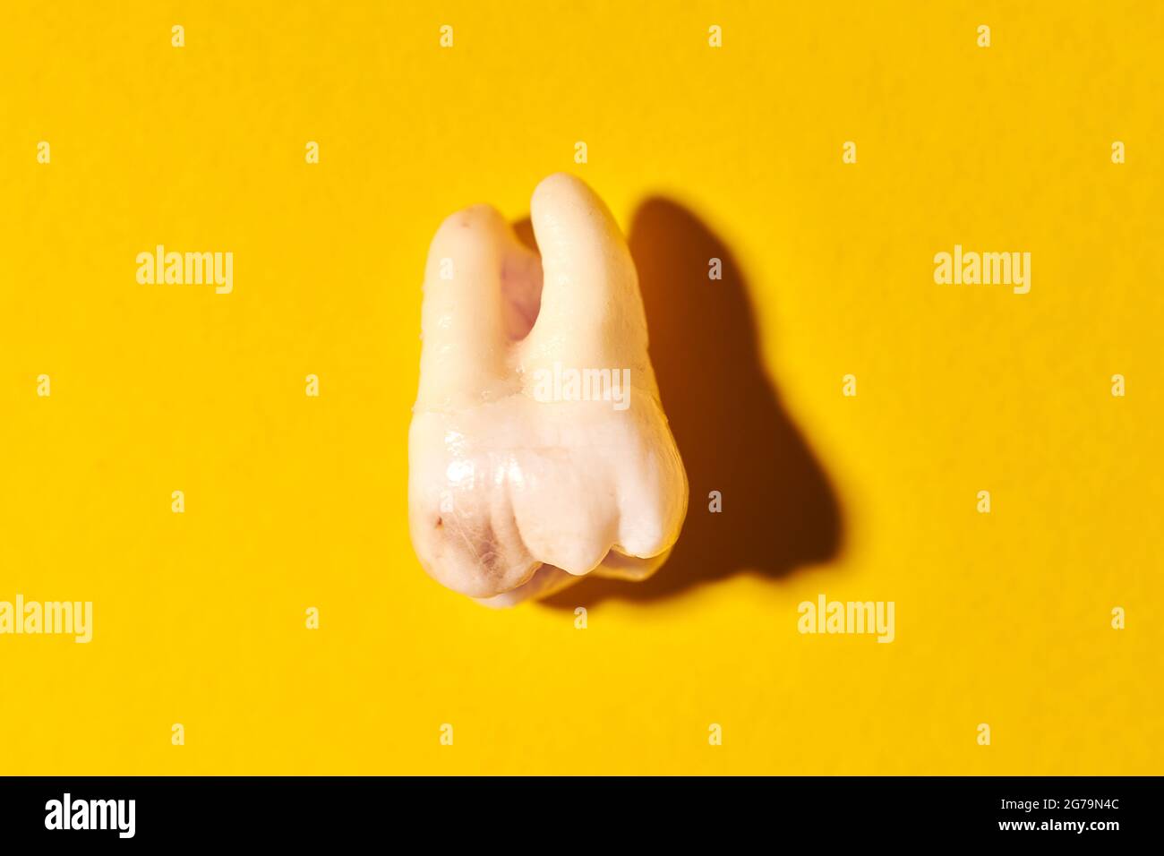 Wisdom tooth with tooth decay, yellow background. Removed third molar ...