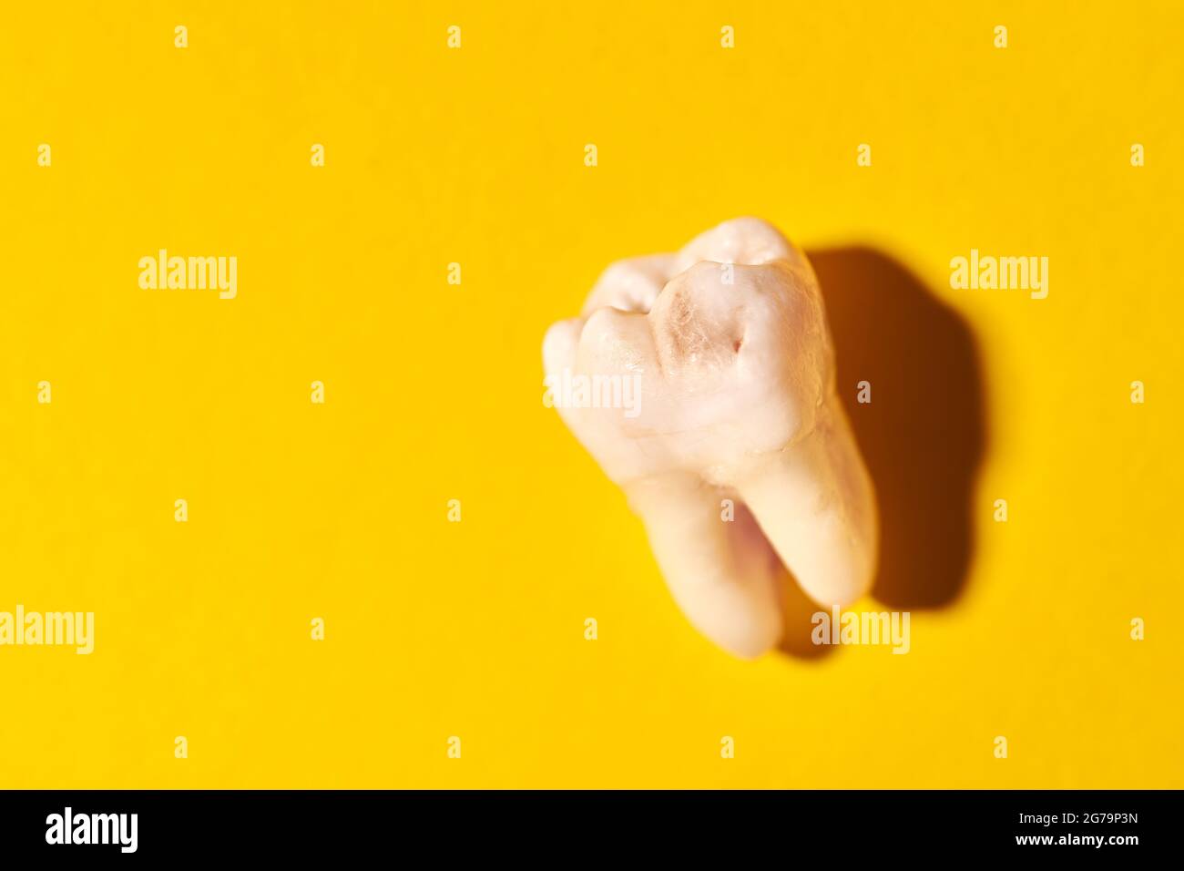 Wisdom tooth with tooth decay, yellow background. Removed third molar ...