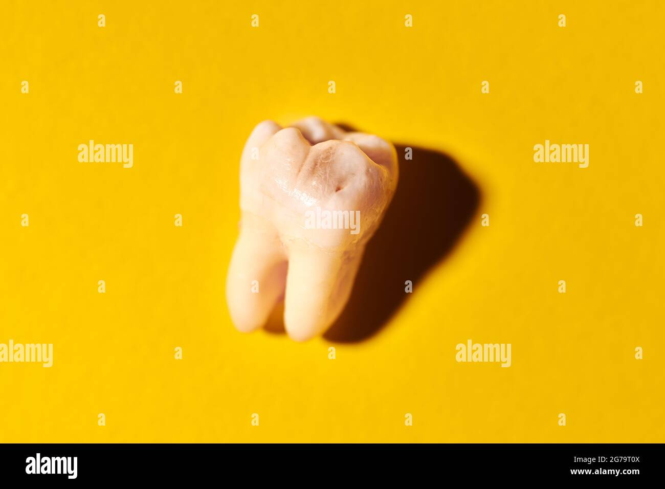 Wisdom tooth with tooth decay, yellow background. Removed third molar ...