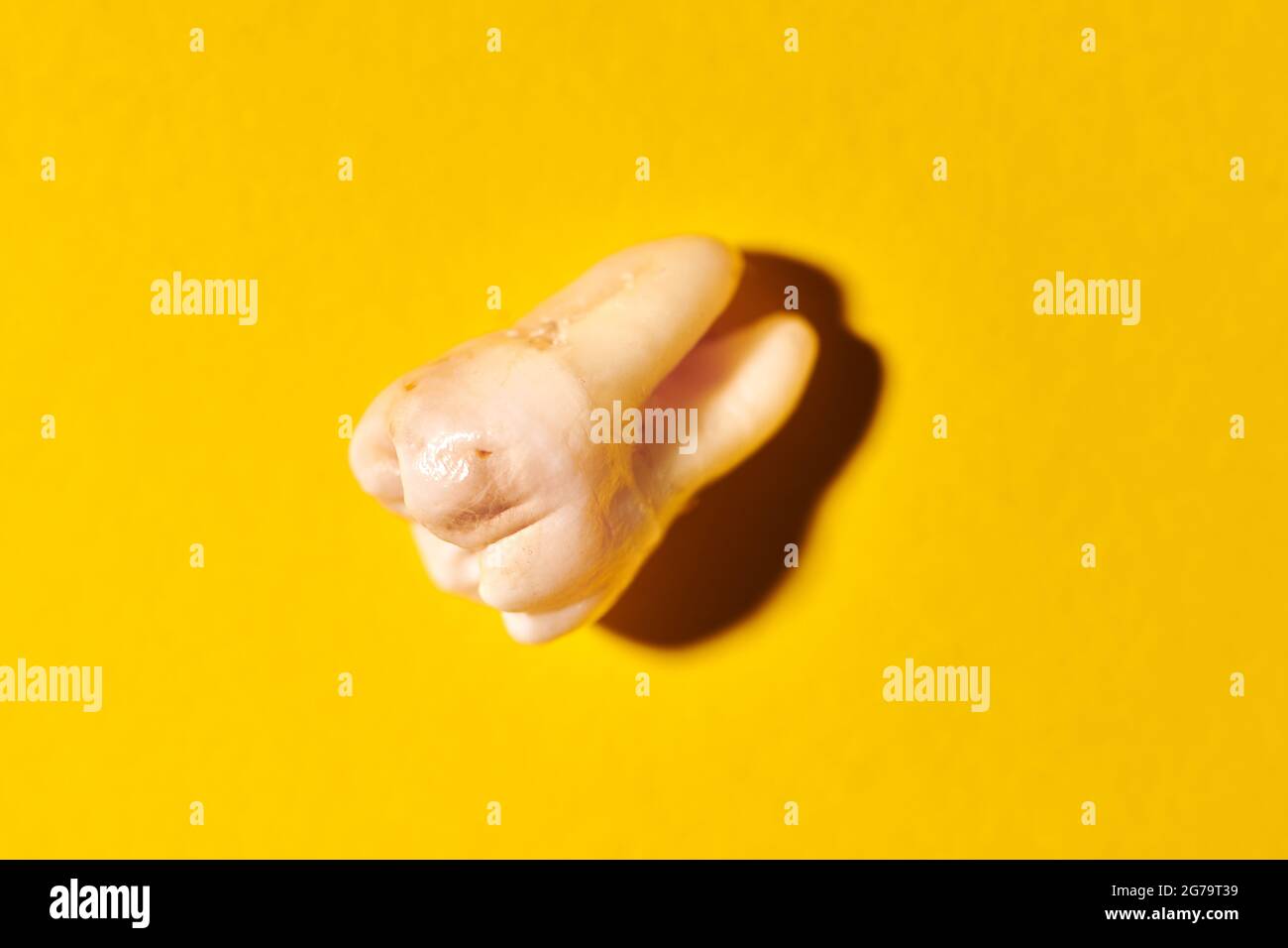 Wisdom tooth with tooth decay, yellow background. Removed third molar ...