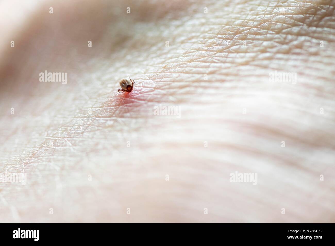 Castor Bean Tick (Ixodes ricinus), tick on human skin, tick bite Stock ...