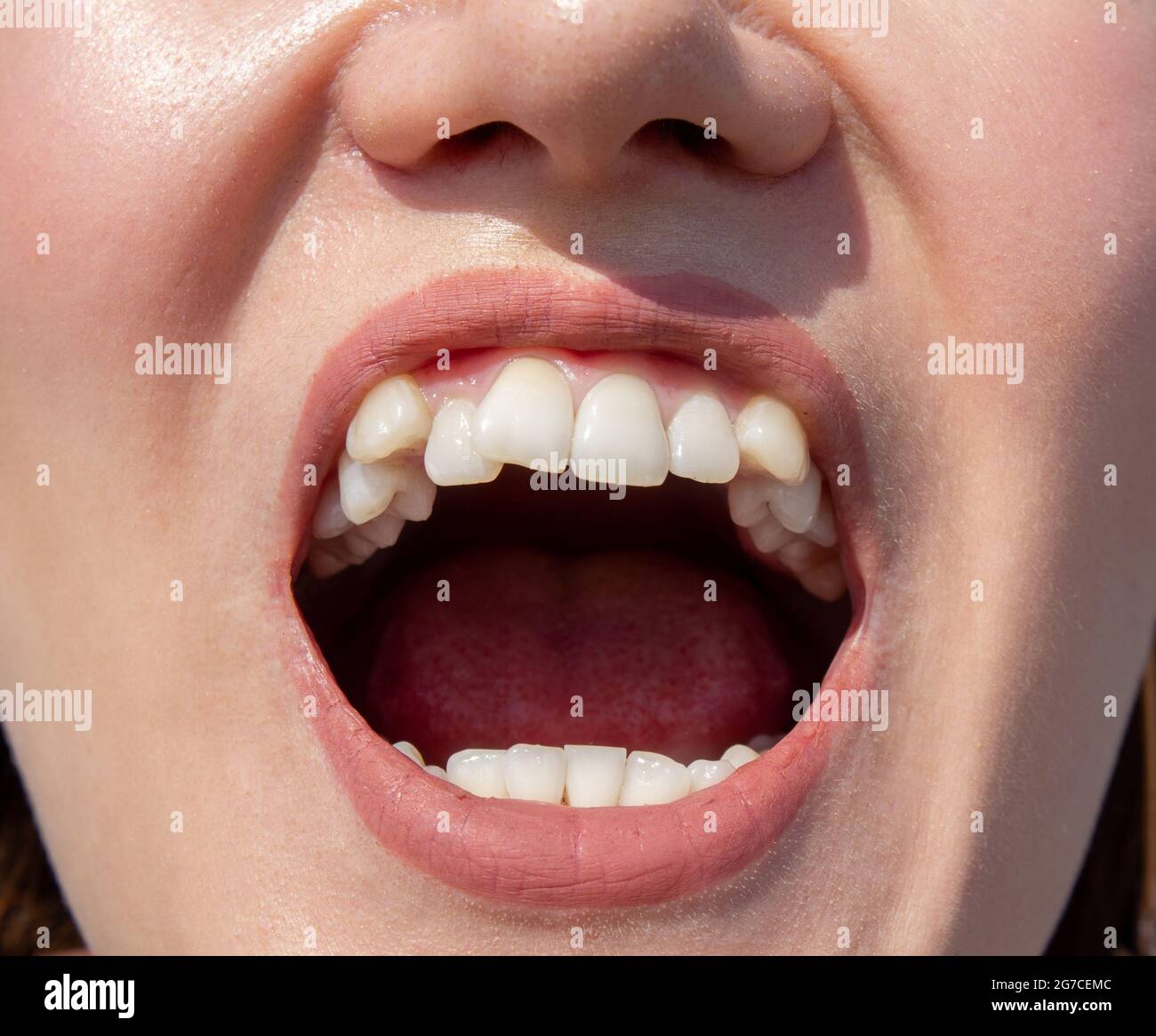 Curved female teeth, before installing braces. Close - up of teeth ...