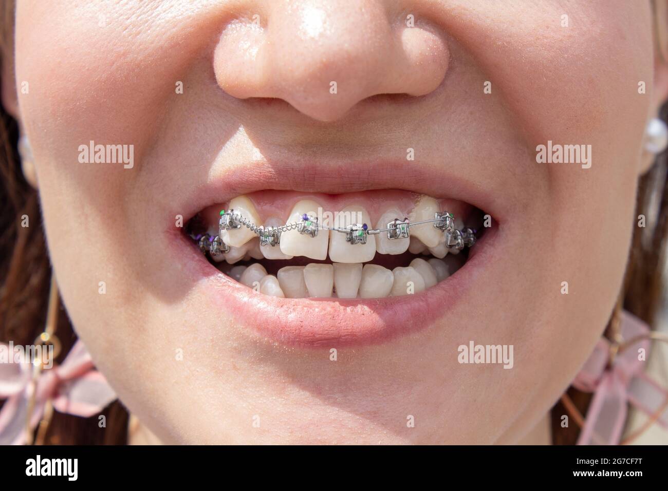 Curved female teeth, after installing braces. Close-up of the teeth ...