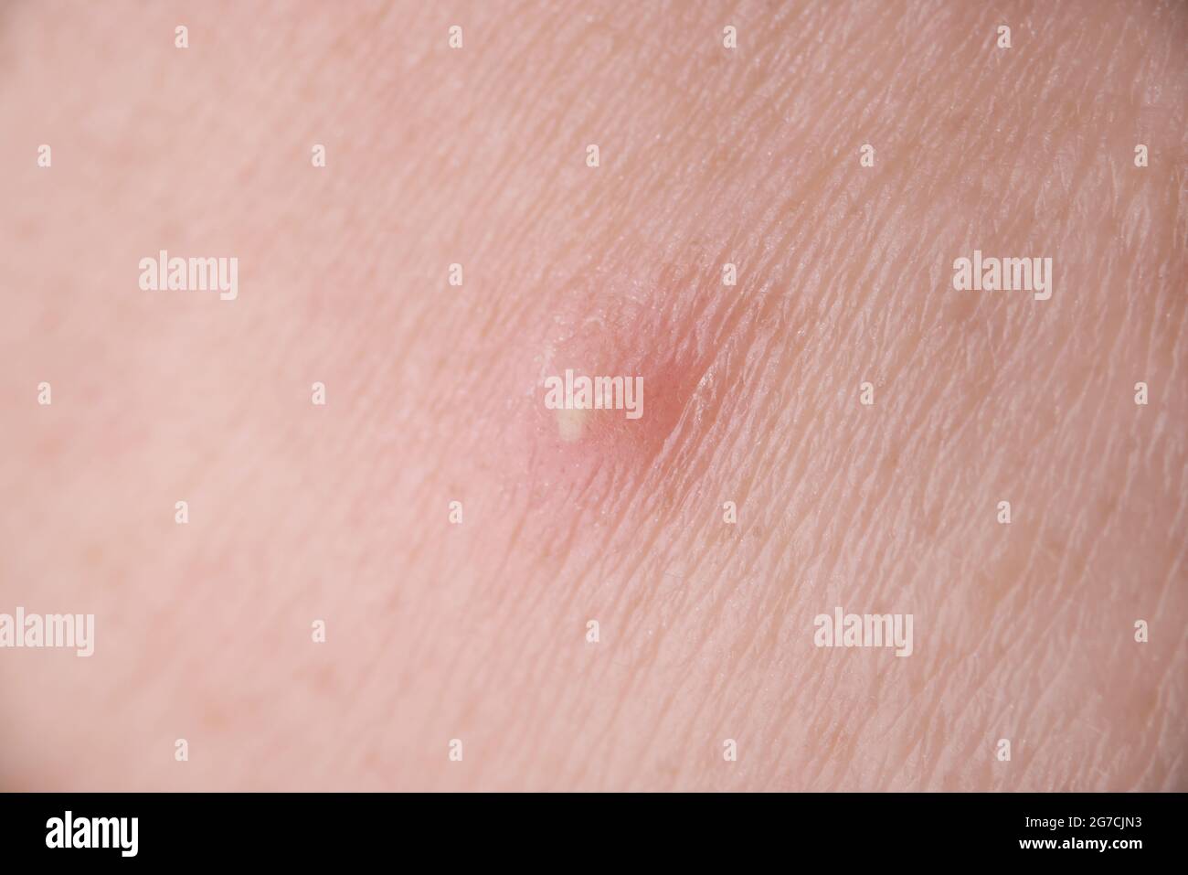 Face skin rash close up hi-res stock photography and images - Alamy