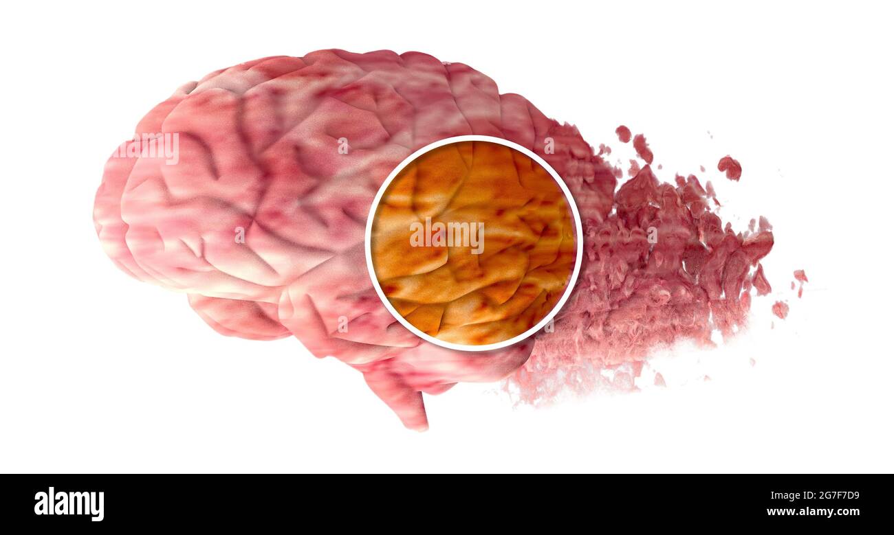 Memory lapses, forgetting things, degenerative disease. Brain problems ...