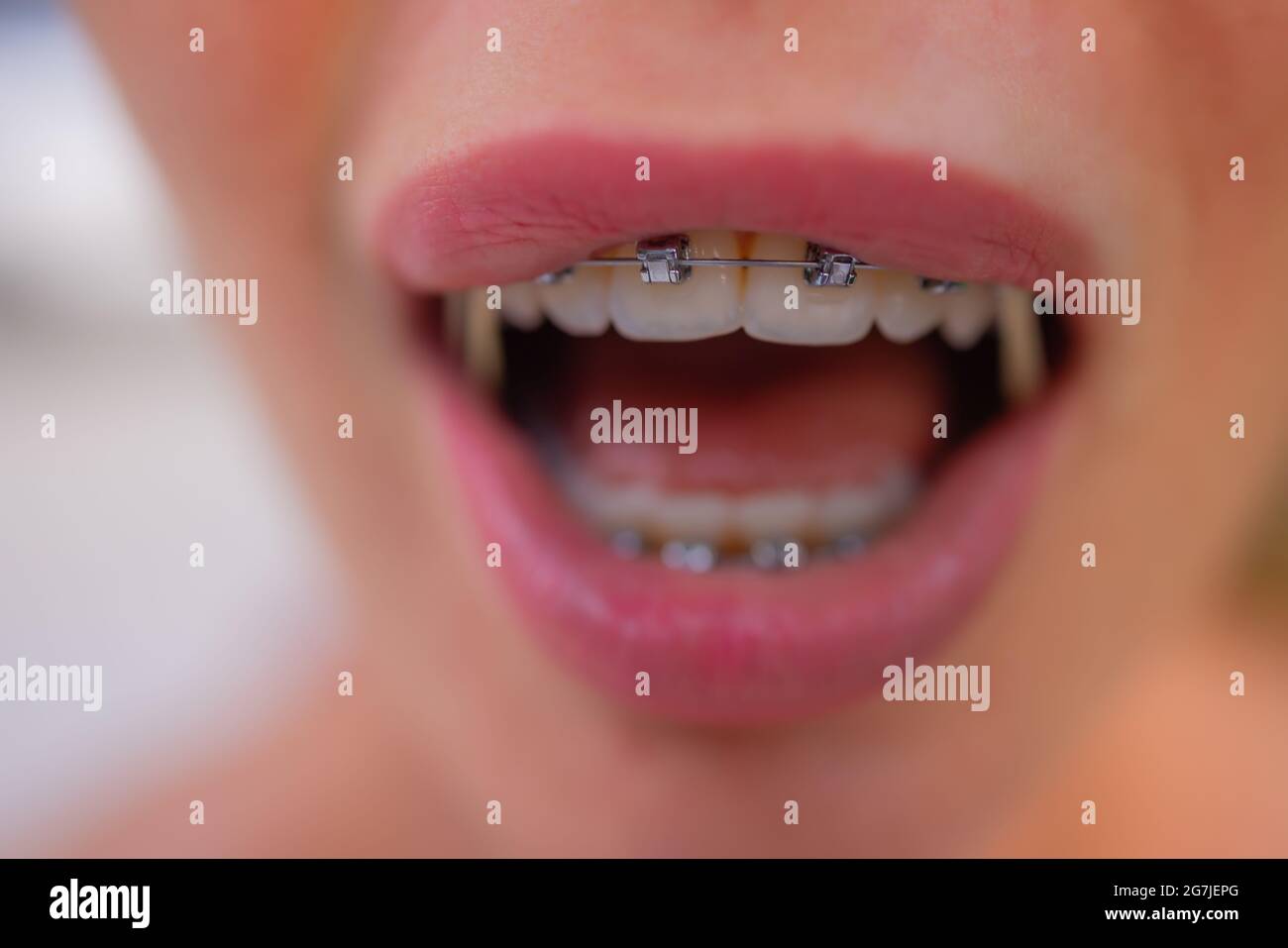 Beautiful young woman with brackets on teeth close up Stock Photo - Alamy