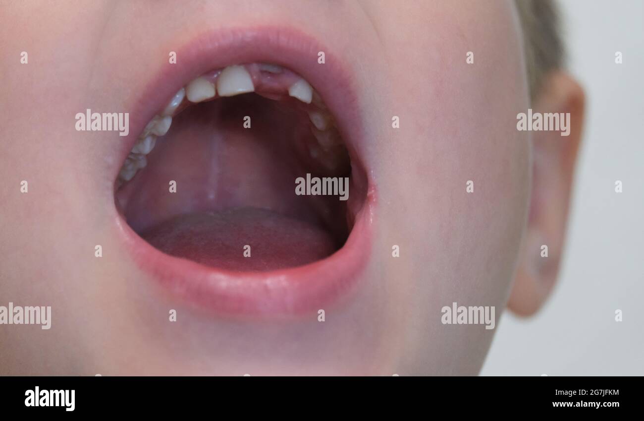 Boy's mouth without front tooth Stock Photo - Alamy
