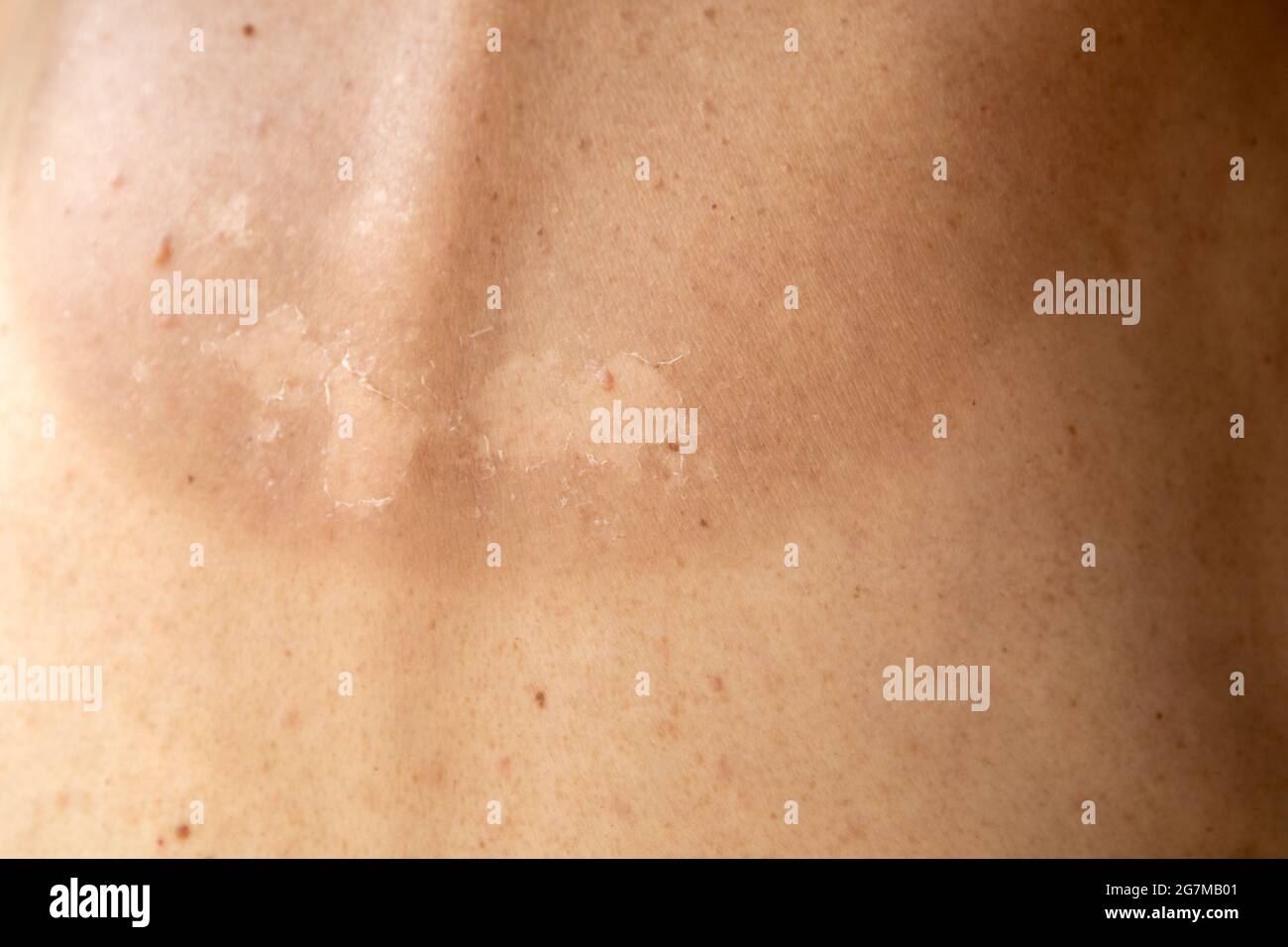 Burnt skin, birthmarks and texture. Beauty and health Stock Photo - Alamy
