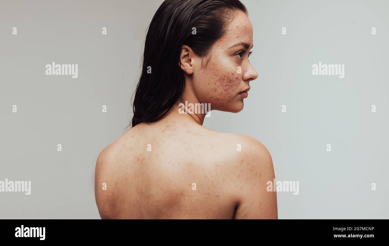 Portrait of woman having acne inflammation on face and body. Rear view ...