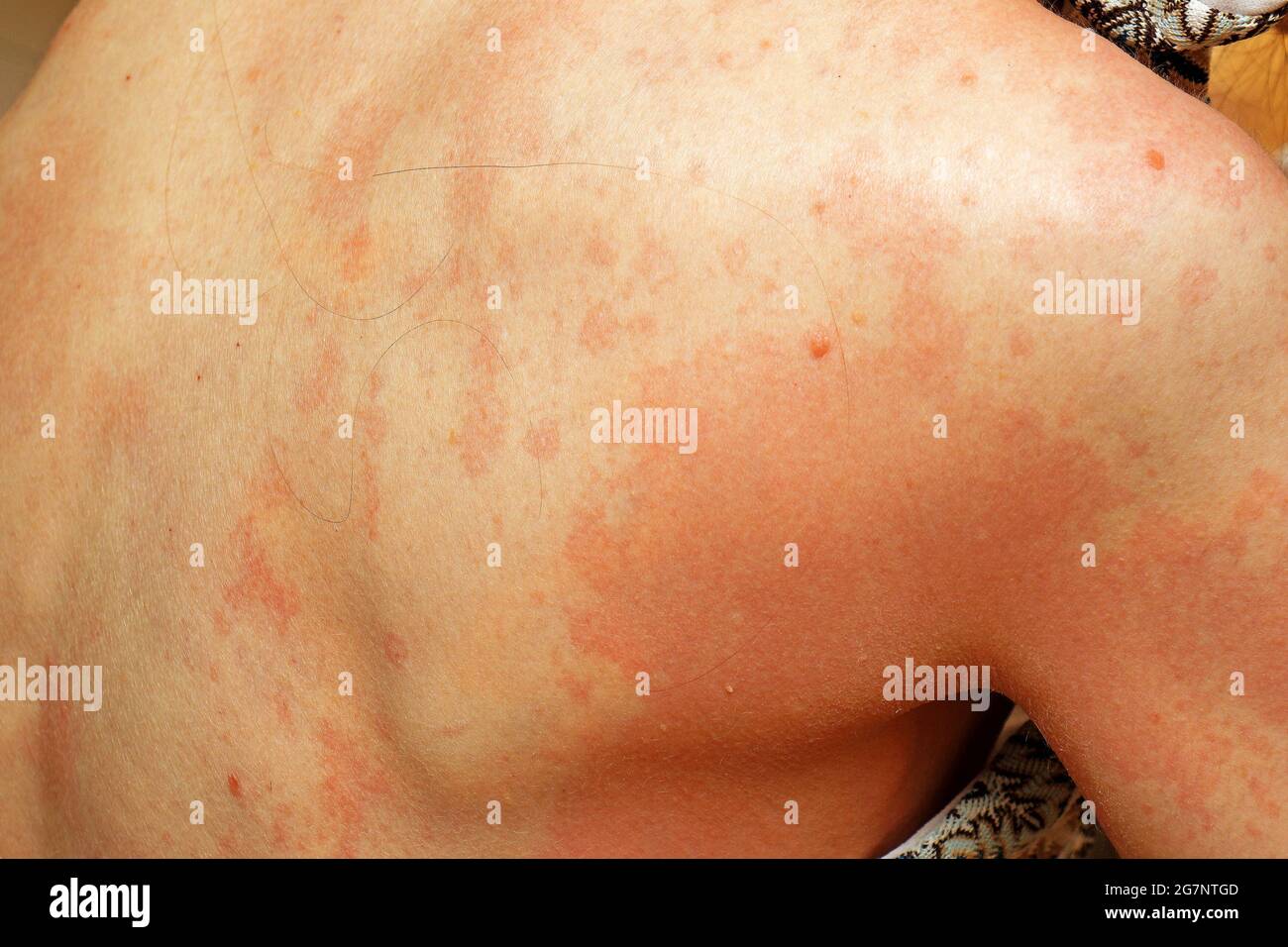 Severe red spots allergy on back body skin Stock Photo - Alamy