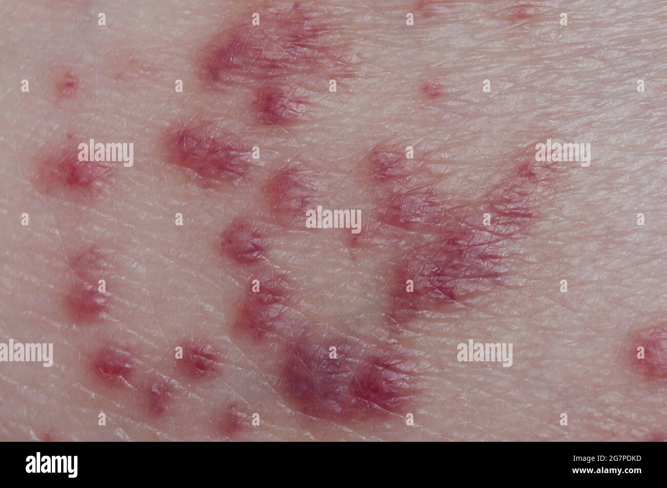 Rash on human skin due to chiggers, Family Trombiculidae Stock Photo ...