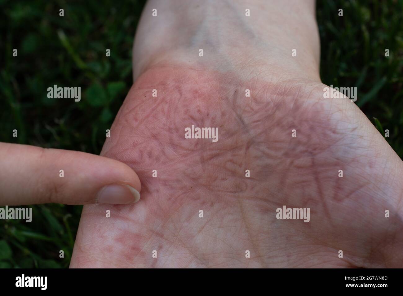 Girl showing the stains on her skin from the grass Stock Photo - Alamy