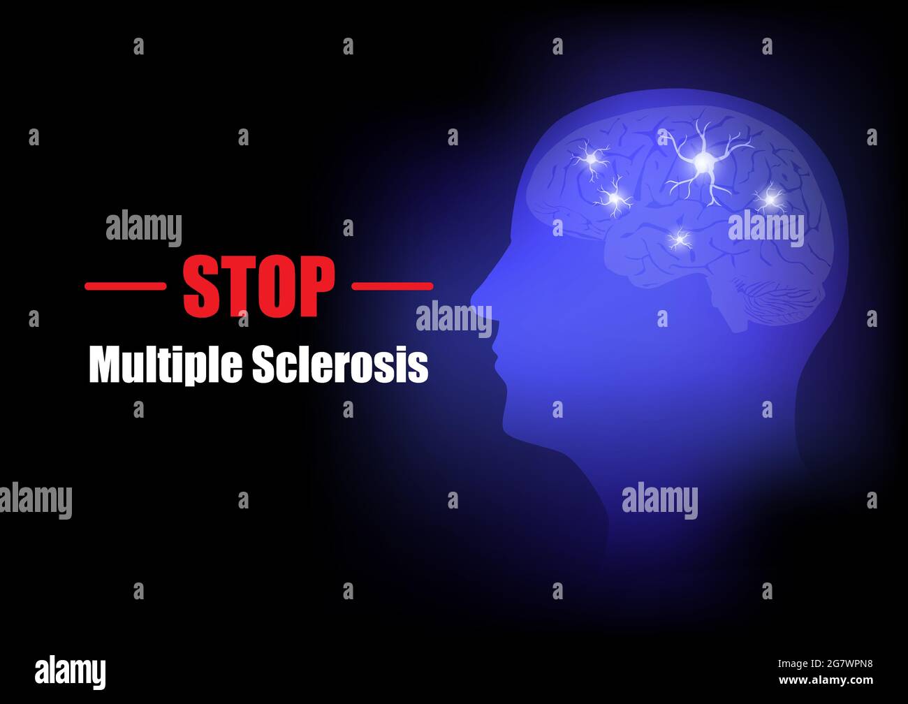 World brain day campaign 2021. Concept of stop multiple sclerosis ...